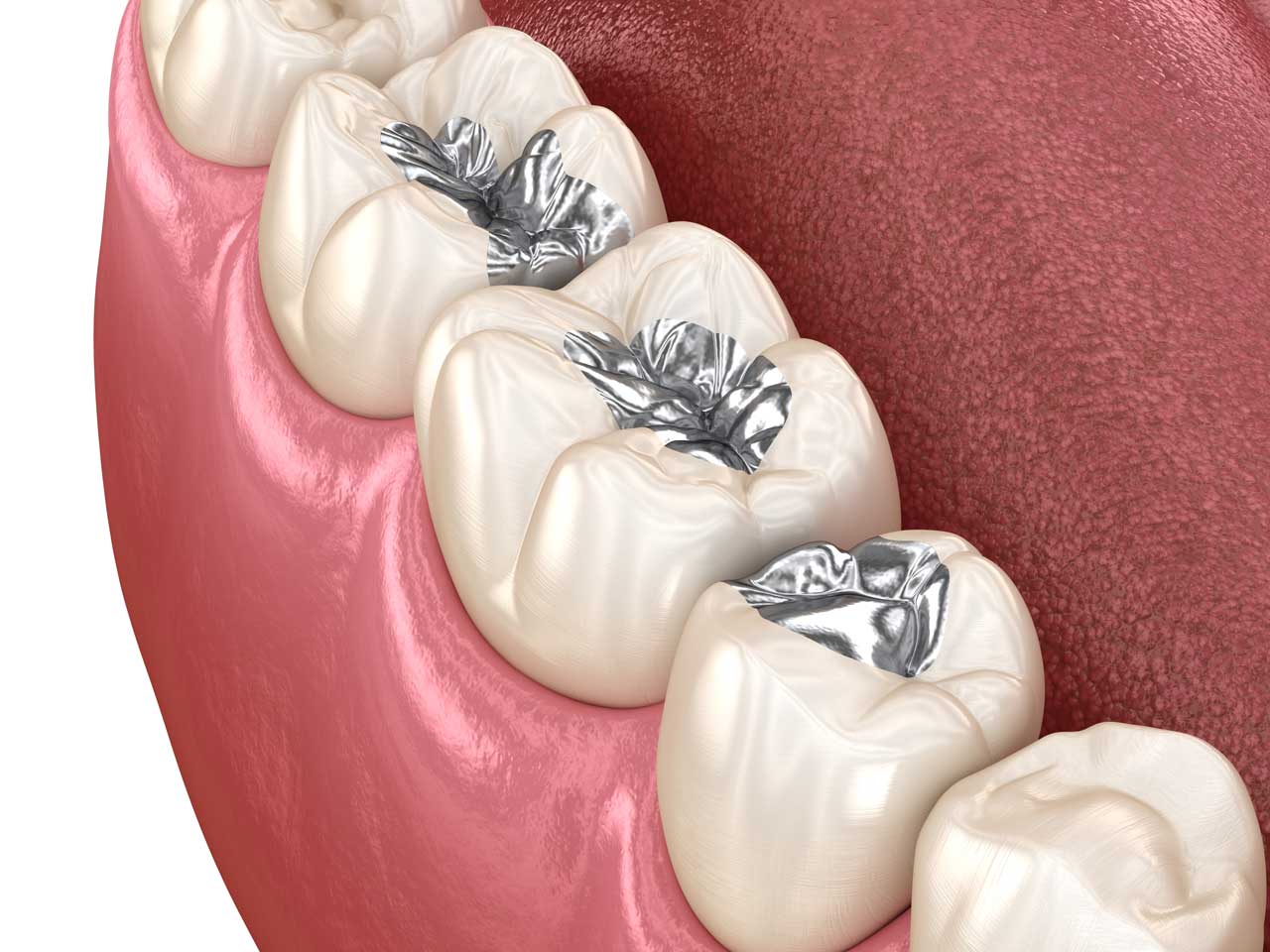Amalgam restoration – NIR dental