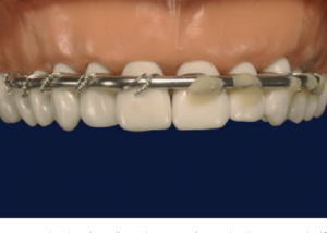 Arch bar splinting/arch – NIR dental