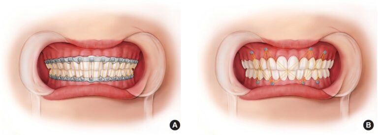 Intermaxillary fixation – NIR dental