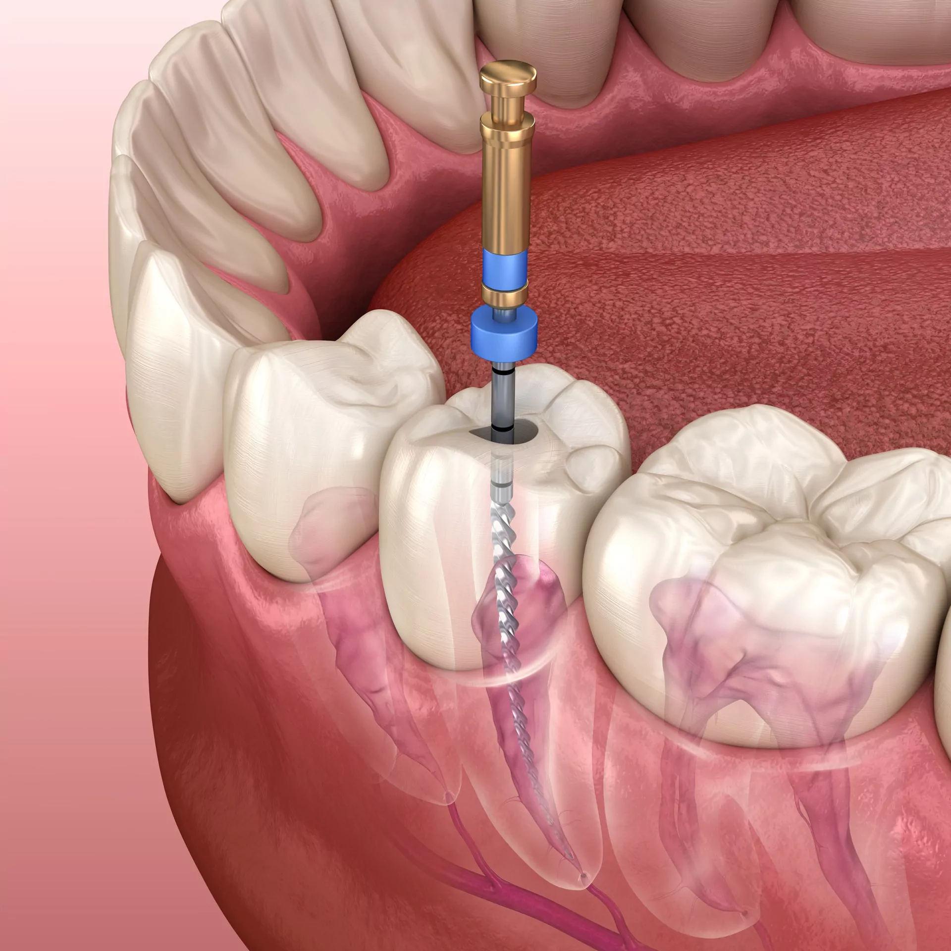 RCT Anterior Teeth – NIR dental