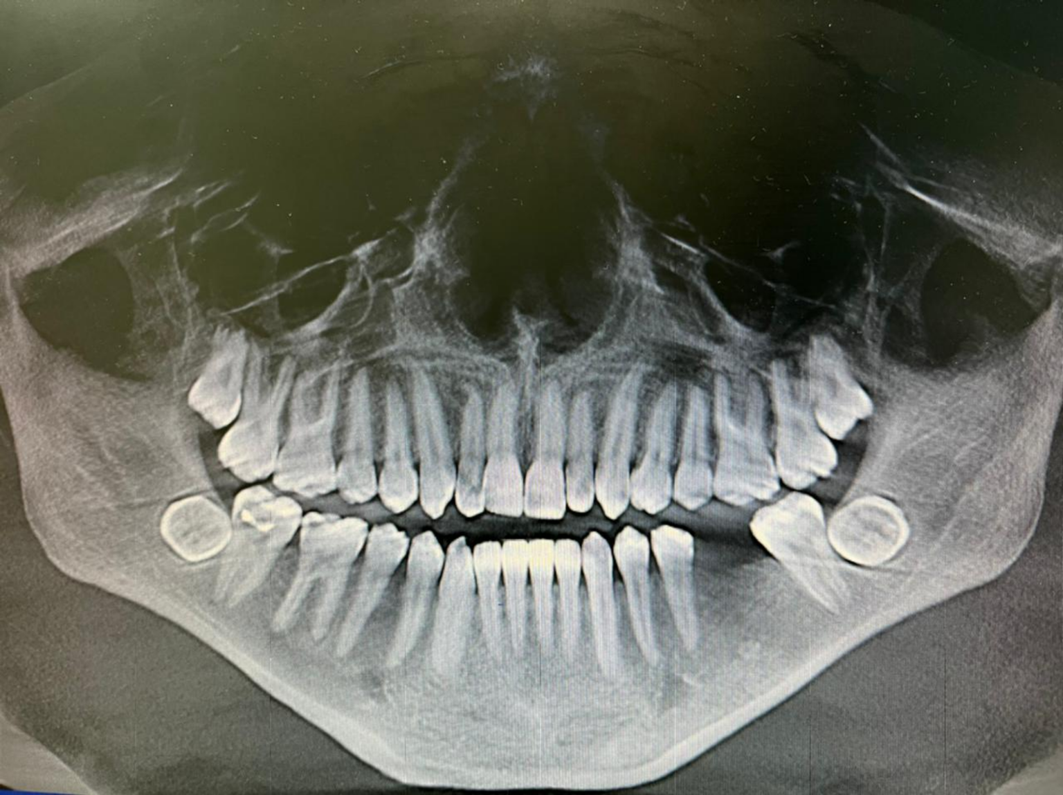 Upper 3rd molar extraction – NIR dental